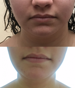 REVIEWED: ChinUp, the natural treatment that claims to lift a double ...