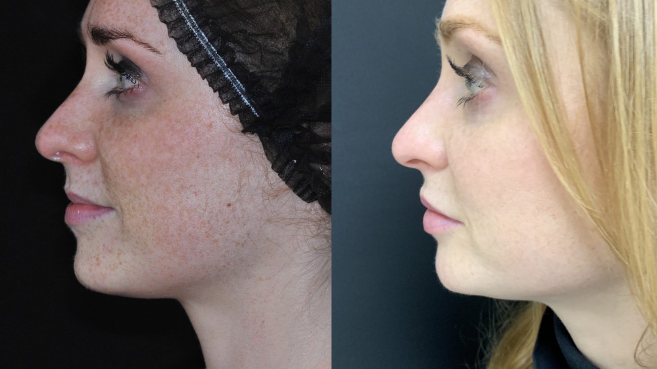 Lip fillers fixed my smoker's lines without giving me the dreaded trout ...