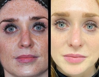 Smokers Lips Before And After | Lipstutorial.org