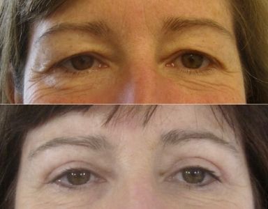 The 30-minute eye lift that transformed this woman's face - Healthista