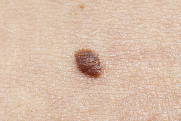 Warning signs of cancerous moles and what to do about them - Healthista