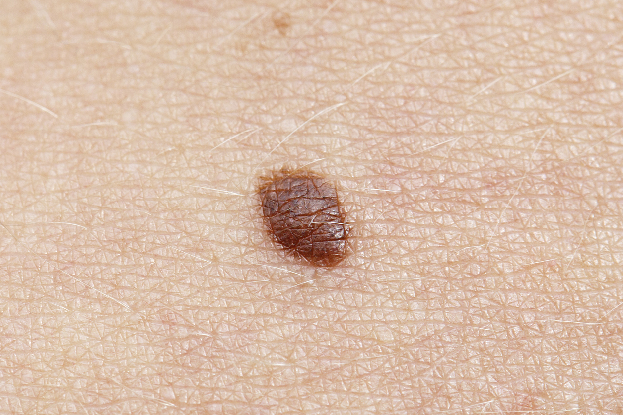 Warning signs of cancerous moles and what to do about them - Healthista