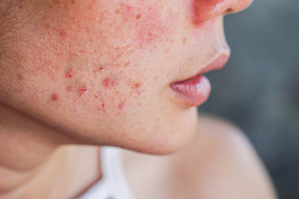 Bad skin? Here's what your spots are trying to tell you about your health