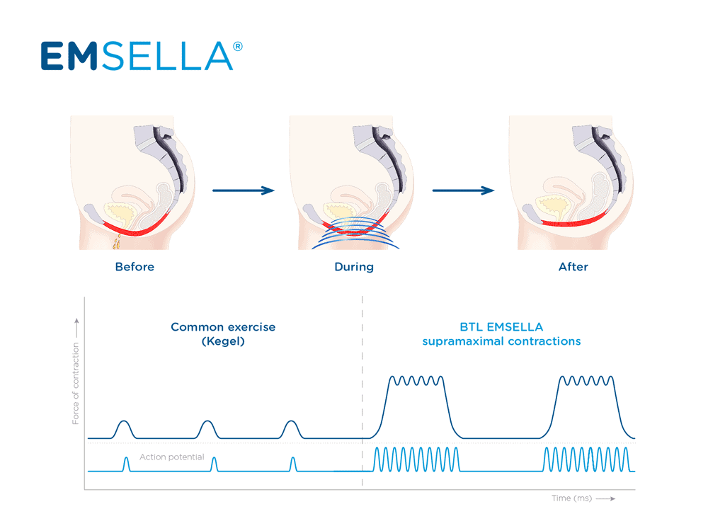 Emsella - the pelvic floor makeover treatment that will help cure your ...